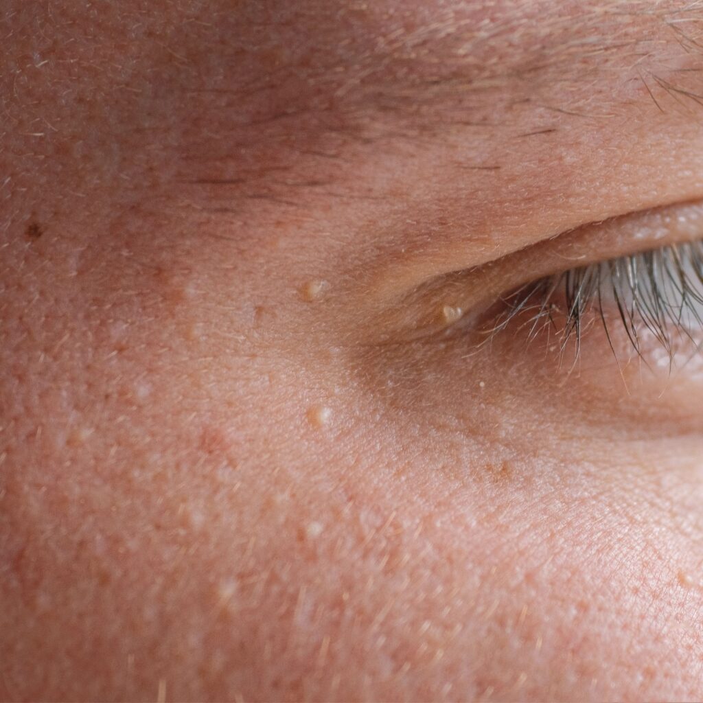 Milia Remove Treatment Marbella - Skin Solutions